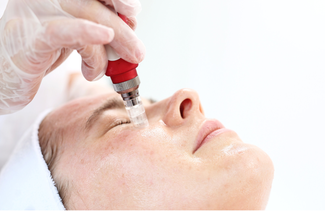 How Deep Should You Be Microneedling? – Skin Science by Mira
